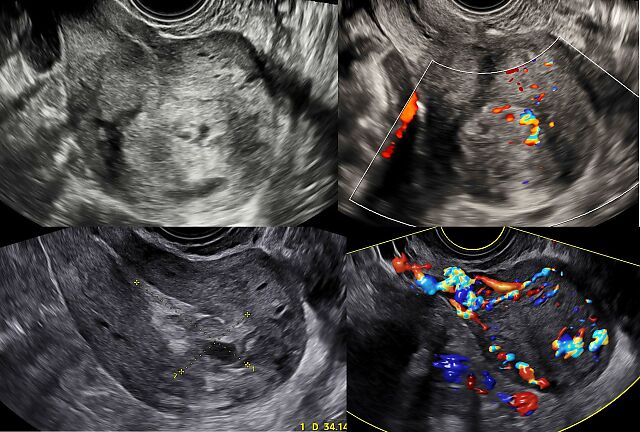 Ultrasound Diagnosis and Management of Trophoblastic Disease | Article ...